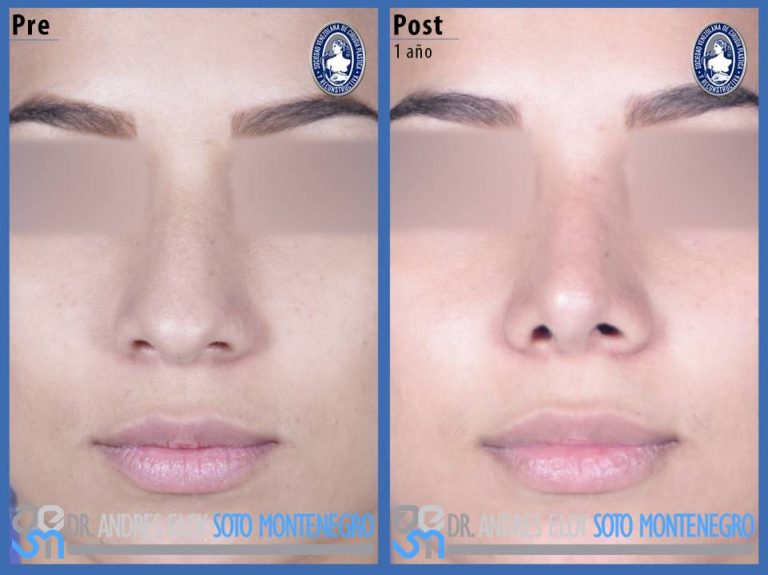 DERMOLIPECTOMIA Y MINIDERMOLIPECTOMIA ABDOMINAL – Dr. Soto Montenegro